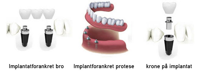 implantatforankret-bro-implantforankret-protese-krone-pa-implantat